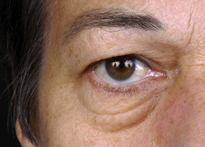 Cernes et poches sous les yeux: les meilleurs conseils pour les résorber