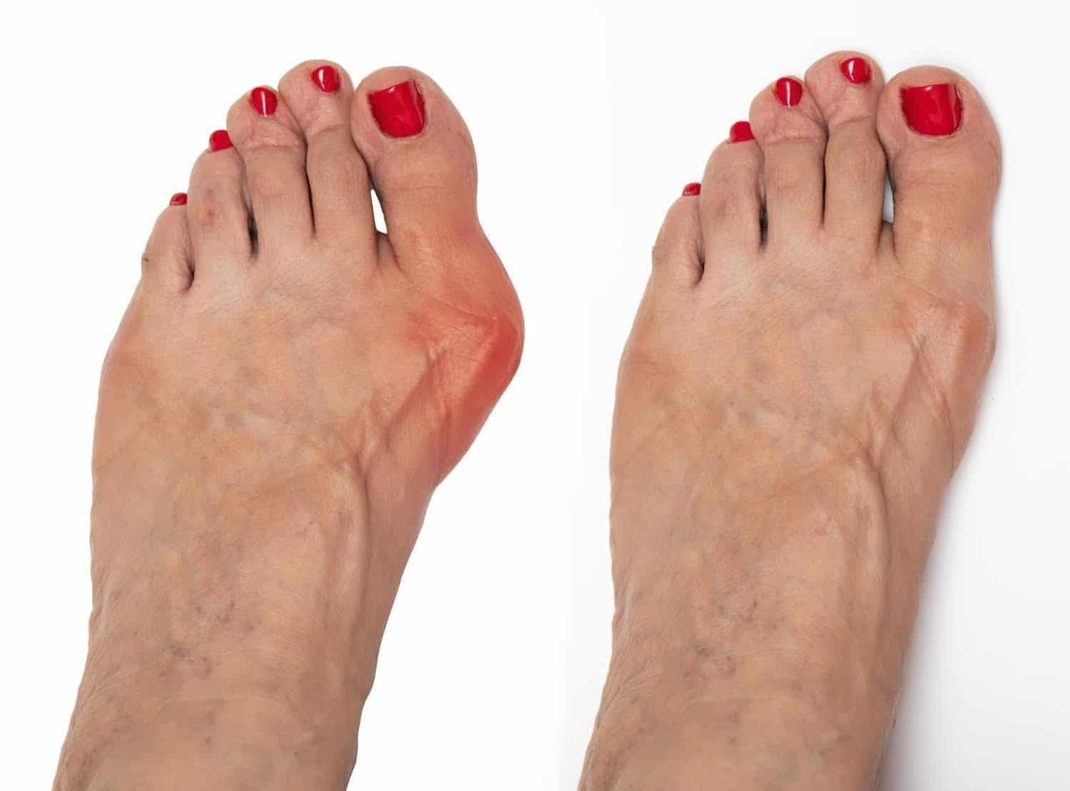 Hallux valgus : Il est temps de faire attention à la santé de vos pieds