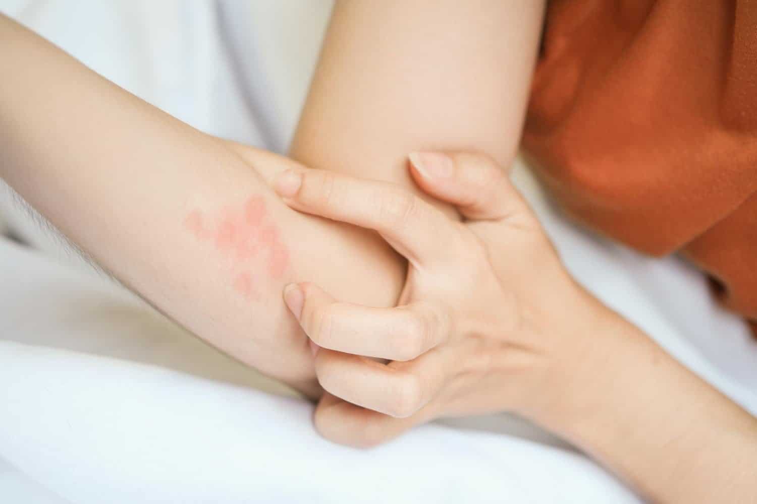 Eczéma: le lien avec les bactéries de l'intestin se précise