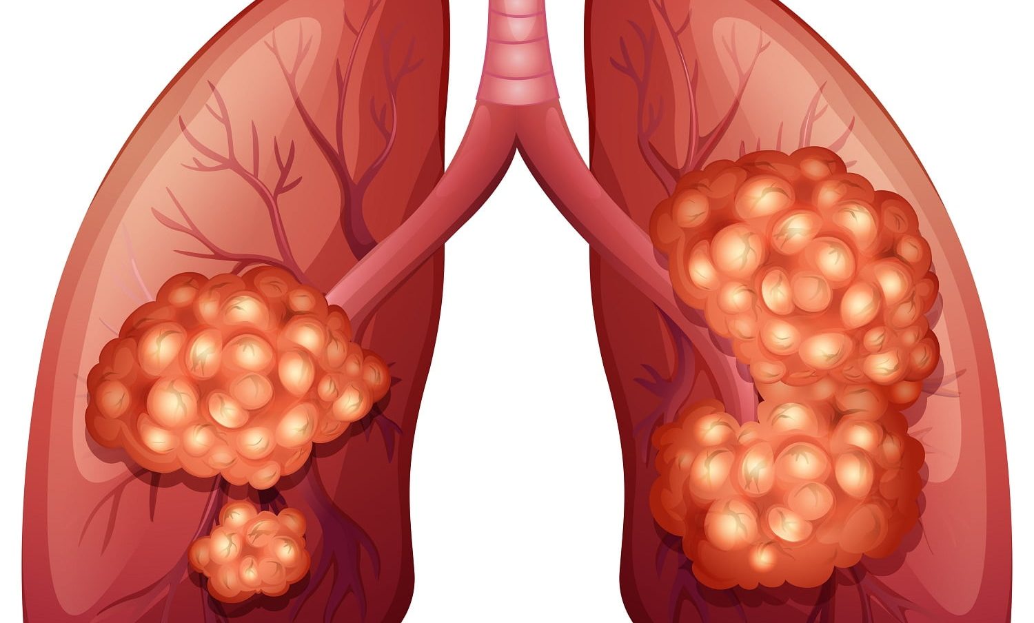 Complications du cancer du poumon : reconnaître les signes et les gérer