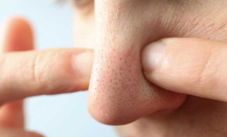 Points noirs Vs filaments sébacés : Quelle est la différence